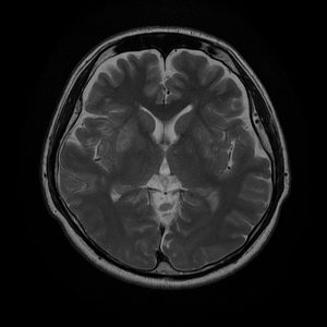 無症状の脳疾患 - medock 総合健診クリニック