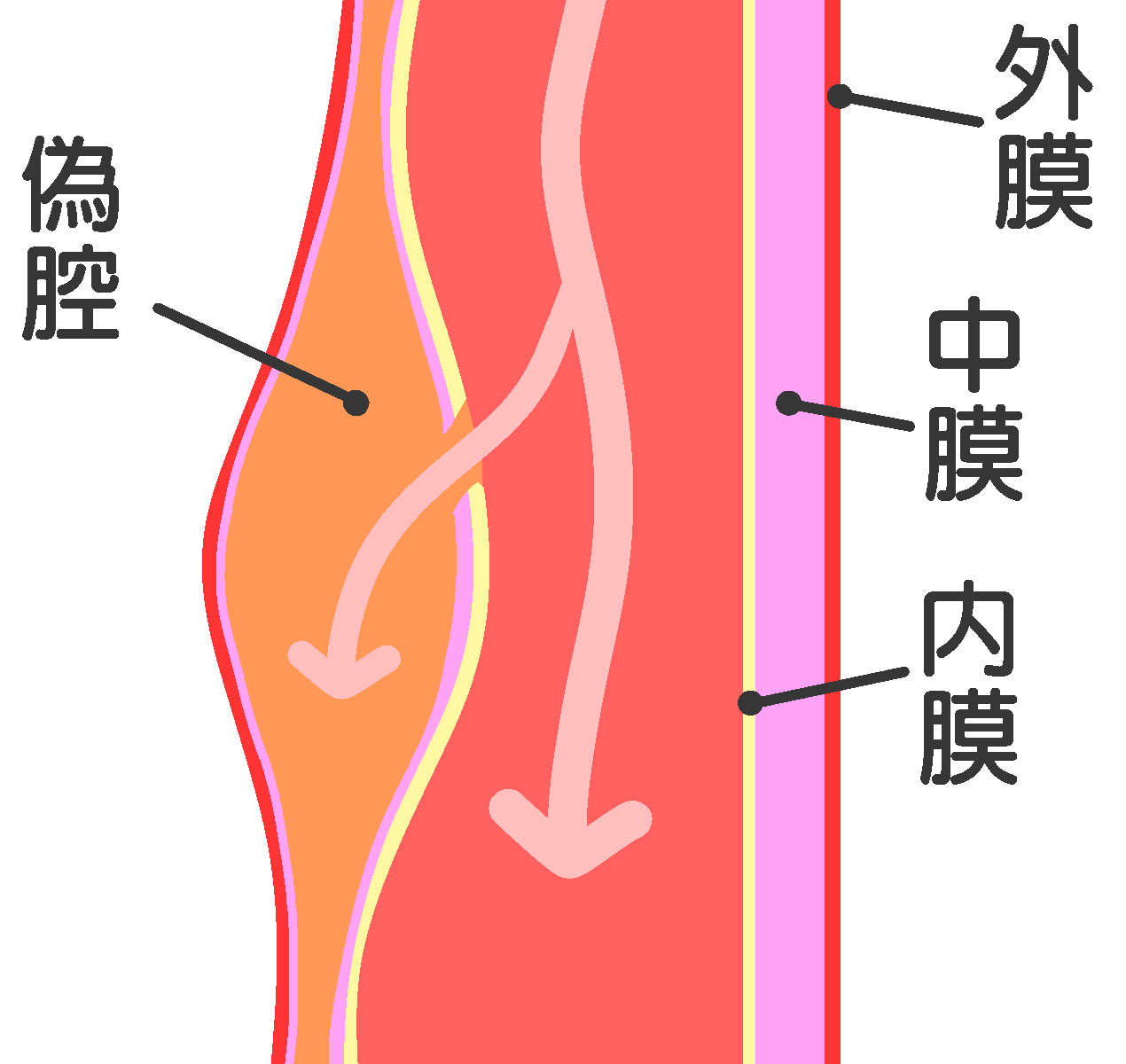 大動脈解離 - medock 総合健診クリニック